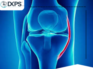 Restoring Stability: MCL Injury Insights & Rehabilitation at DKPS