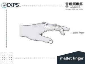 Mallet finger - Drsinghphysiocare